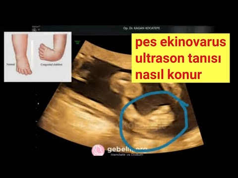 Doğumsal çarpık ayak (pes ekinovarus) - (clubfoot, PEV) ultrason tanısı nasıl konur, ne yapılır?