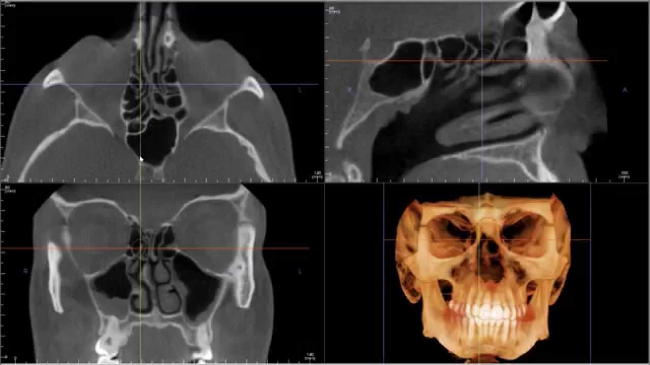 CBCT Interpretation: Paranasal Sinuses Movie Sneak Peak - YouTube