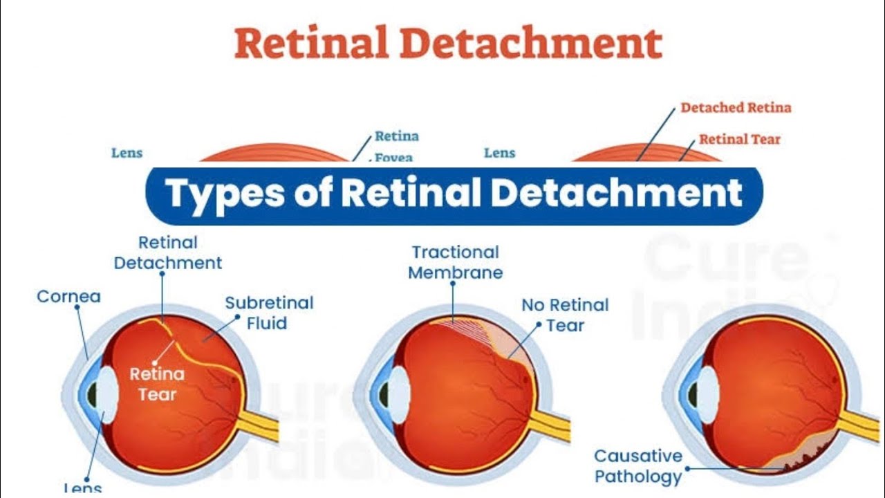 Retinal detachment: Definition, Types, Causes, Risk factors, Symptoms ...