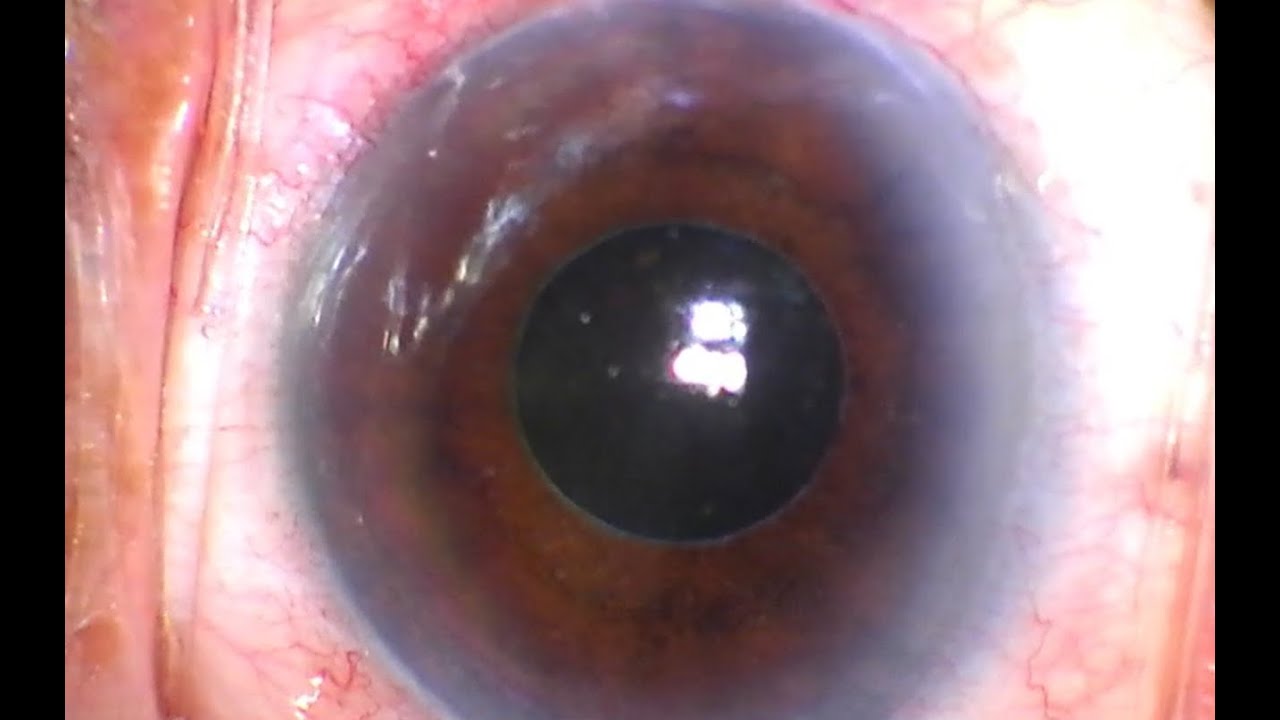 A Big Challenger Case Small Pupil Loss Of Zonular Black Cataract a-big-challenger-case-small-pupil-loss-of-zonular-black-cataract