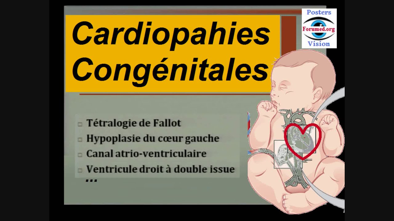 Cardiopathie congénitale cyanogène + fréquentes chez bébé malformation ...