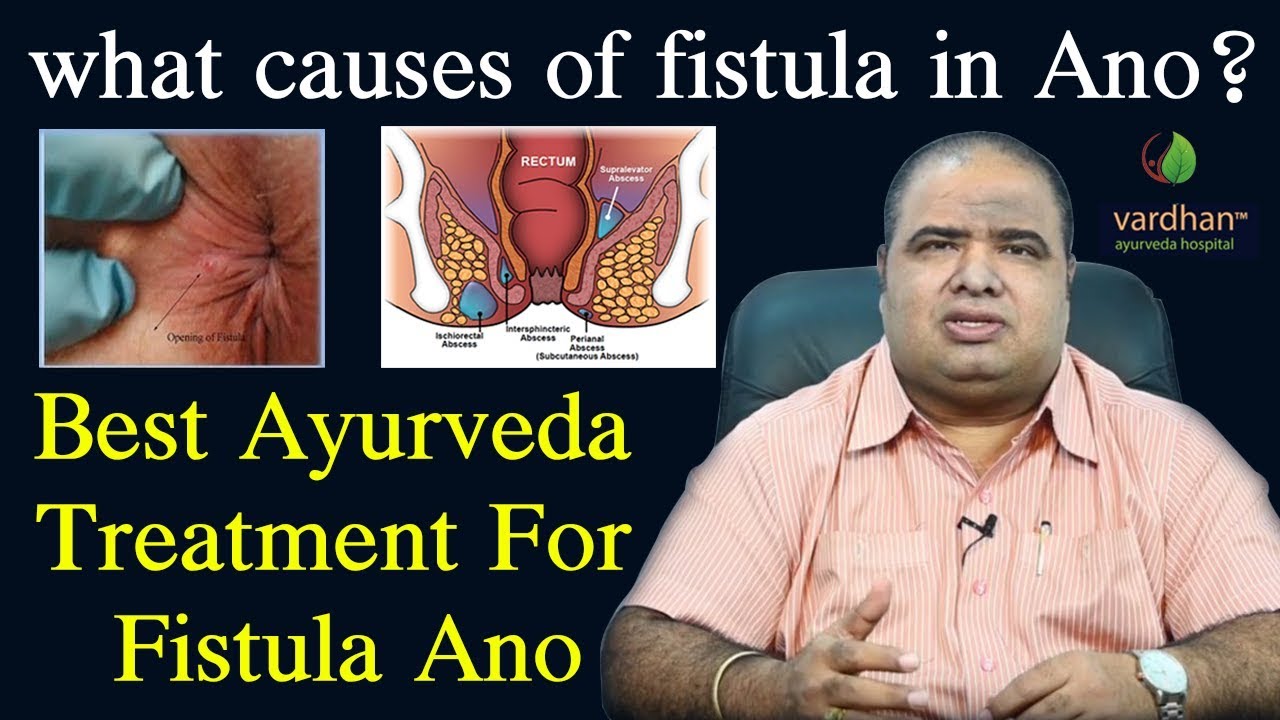 Fistula In Ano Symptoms And Signs