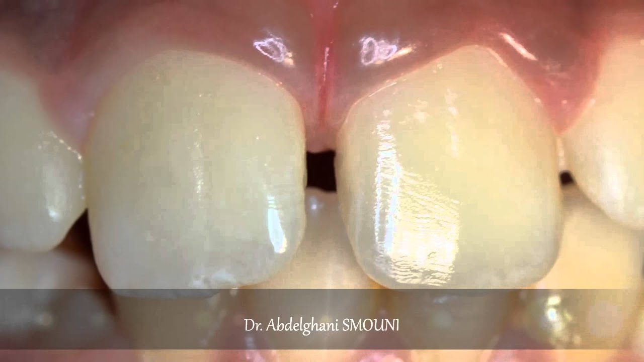 Composite Stratifié - YouTube