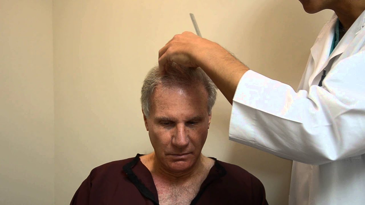 Dr. Jeffrey Epstein - Hair Transplant - YouTube
