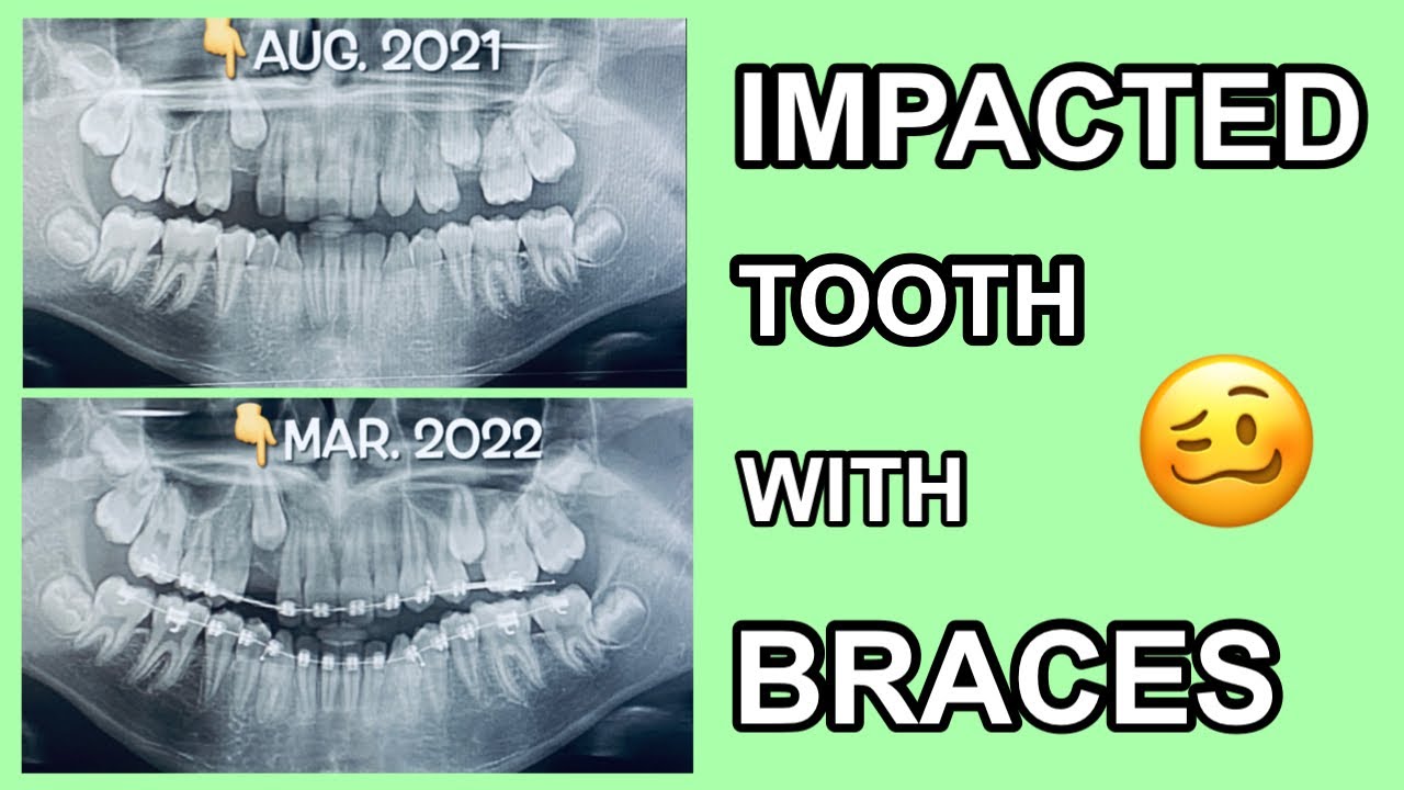 #5 BRACES VISIT PH2 😬 Impacted Tooth⏳Times Up! - YouTube