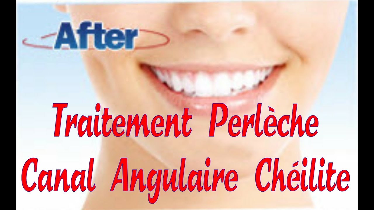 Traitement Perlèche Canal Angulaire de Traitement Chéilite Perlèche ...