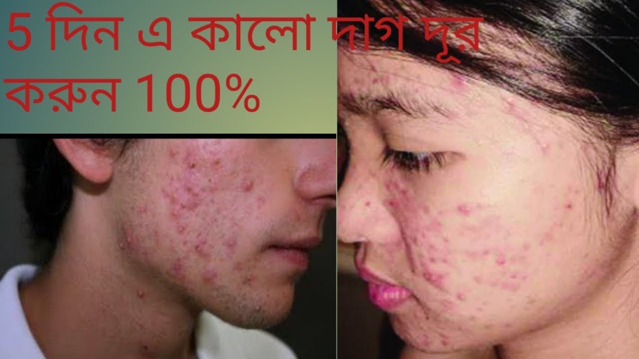 mukher boron e kalo dag dur korun,Ayurved formulai 100% - YouTube