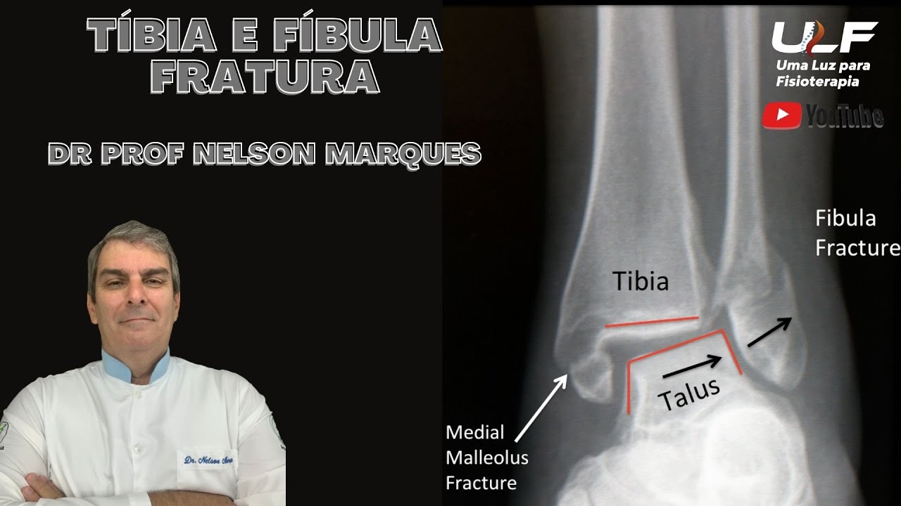 TÍBIA E FÍBULA - FRATURA - Dr. Prof. Nelson Marques - YouTube