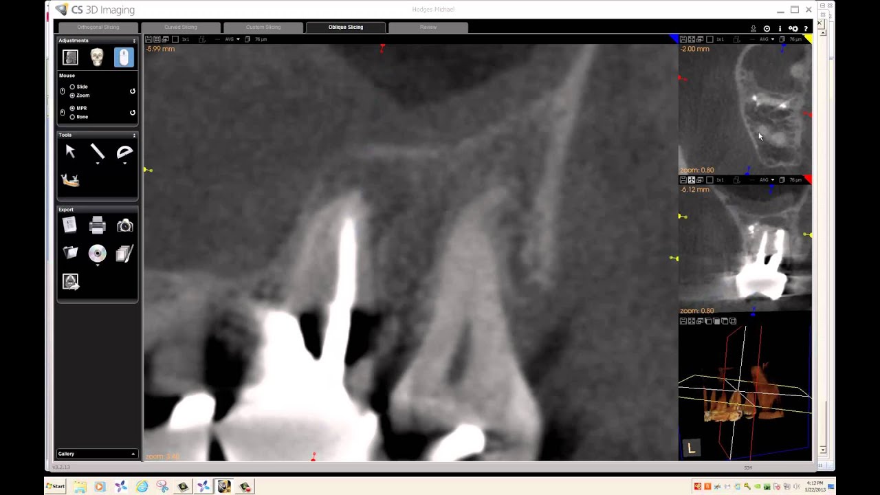 CBCT Screenshots & TDO Clinical Post with TDO Software - YouTube
