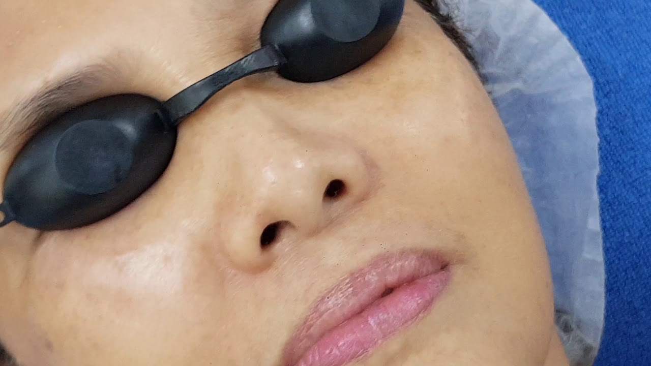 Soft Lasing Technique (SLT) Step 2 - YouTube