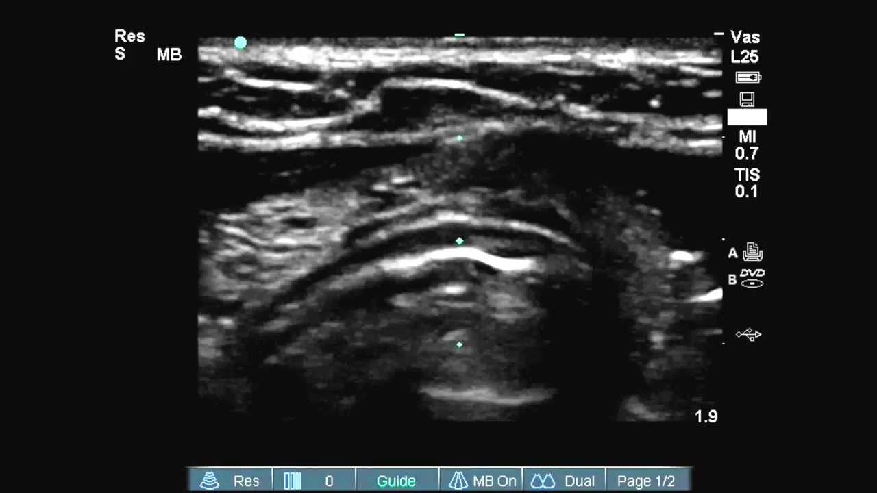 Real time ultrasound guided tracheal puncture during percutaneous ...