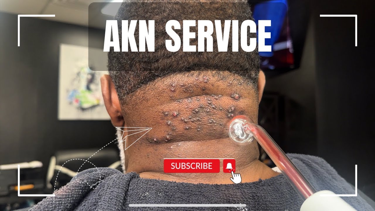 AKN X EXTRACTIONS - YouTube