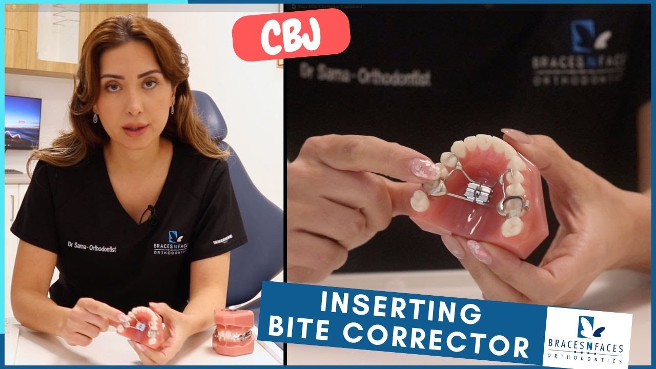 How To Insert Bite Corrector and Turning Your Expander at Home| Braces ...