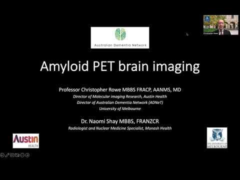 Amyloid PET Brain Imaging - YouTube