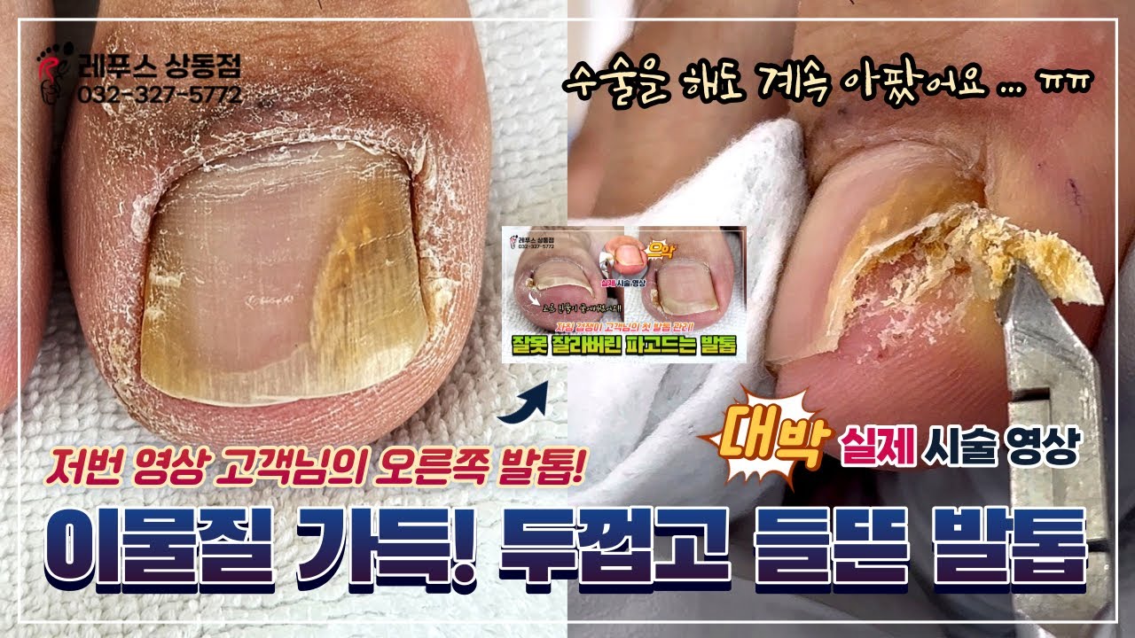 수술을 해도 계속 아팠어요~😵 ㅜㅜ 이물질 가득‼️ 두껍고 들뜬 발톱 스케일링 / Athlete's Foot Toenail ...