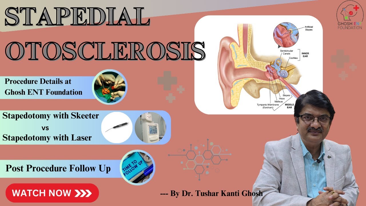 Stapedial Otosclerosis | Procedure | Stapedotomy with Skeeter Vs. Laser ...