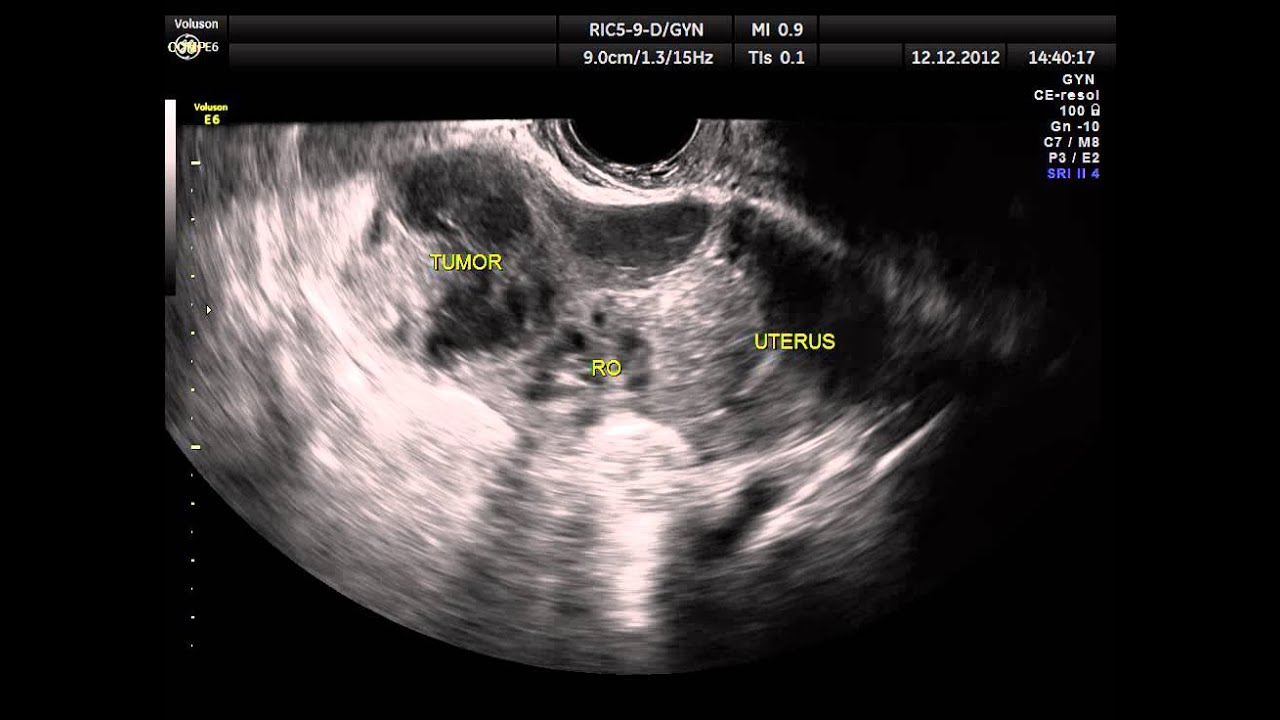 Ectopic Pregnancy Around Right Ovary YouTube ectopic-pregnancy-around-right-ovary-youtube