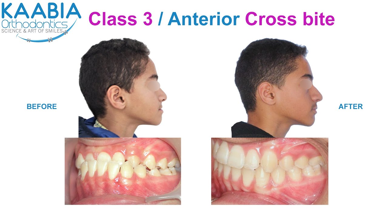 Class 3 anterior cross bite , concave profile.Classe 3 occlusion ...
