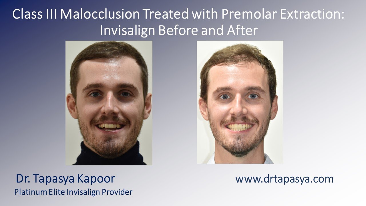 Class III Malocclusion Treated with Premolar Extraction: Invisalign ...