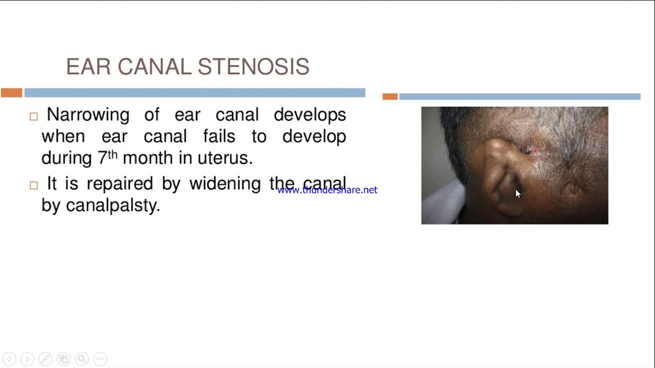 External ear deformity - YouTube