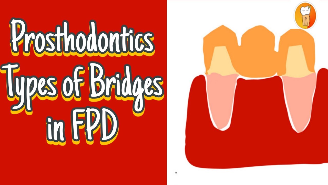 Prosthodontics 🔴Types of Bridges in fixed partial denture 🔴 fpd 🔴 - YouTube