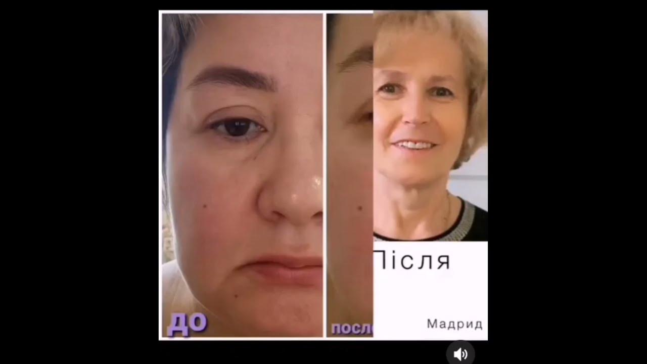 РЕЗУЛЬТАТЫ КОЛЛАГЕН ПРОМАРИН КОРАЛ-КЛАБ - YouTube
