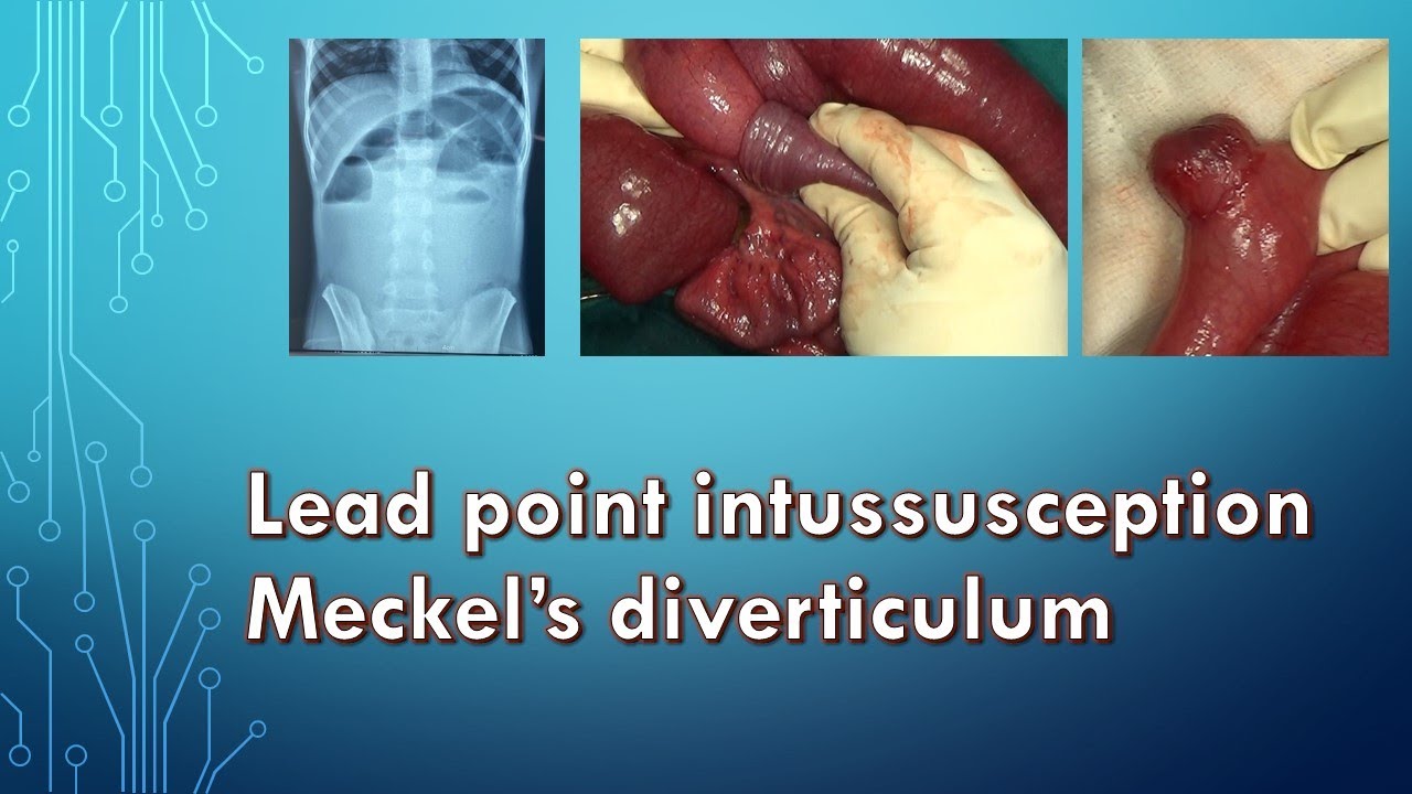 Lead point intussusception - YouTube