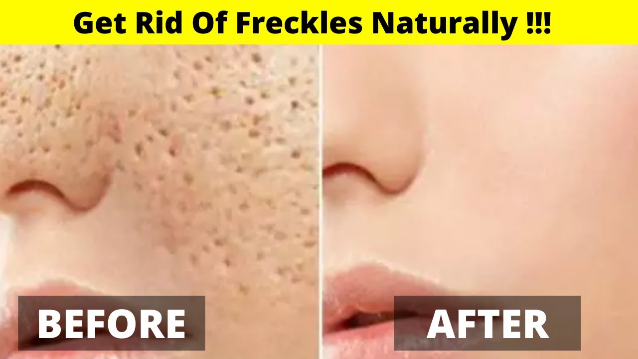 How To Get Rid Of Freckles Permanently || Naturally - YouTube