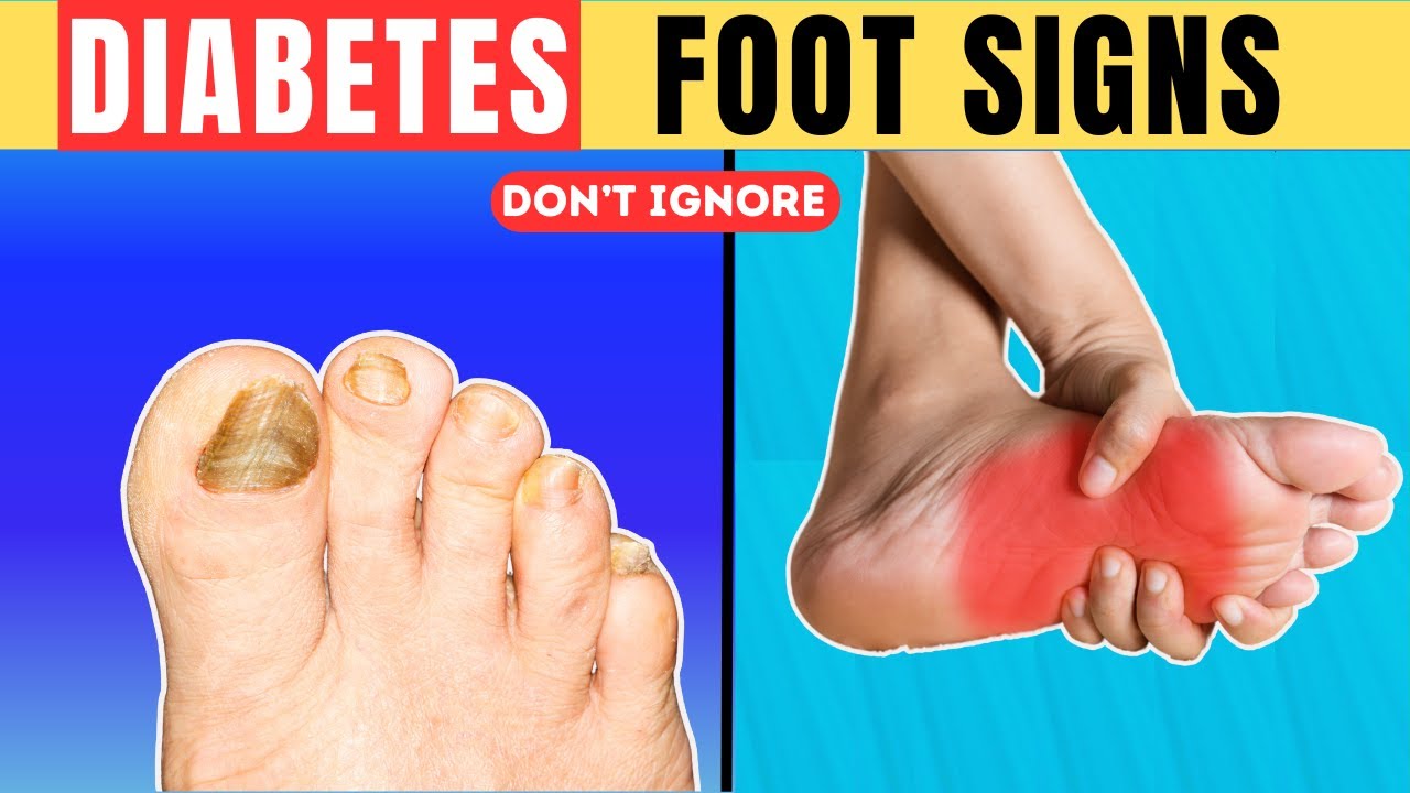 Top 10 Signs Your Feet Tell You About Diabetes - YouTube