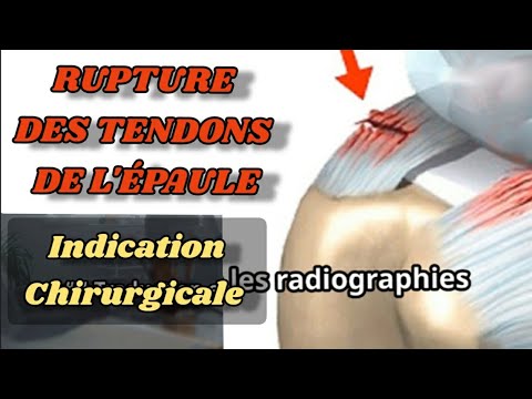 Rupture des Tendons de l'épaule indication chirurgicale Tendinite ...