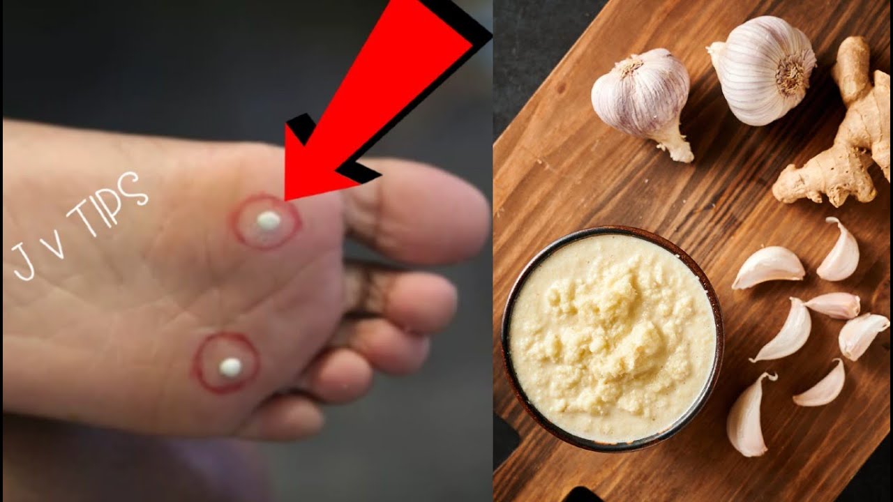 Quick Home Remedy For Verruca || वर्चुका के लिए त्वरित घर उपाय - YouTube