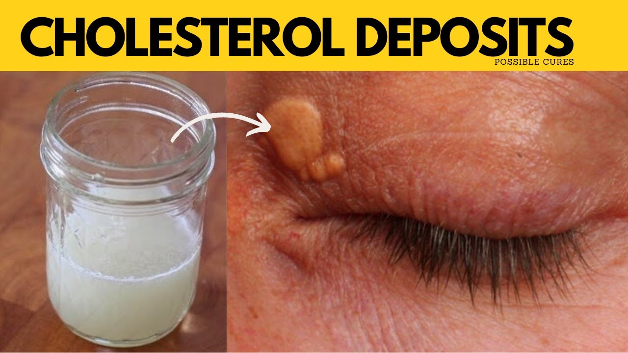 Fastest Way To Get Rid Of Xanthelasma - Squeeze Out Cholesterol ...