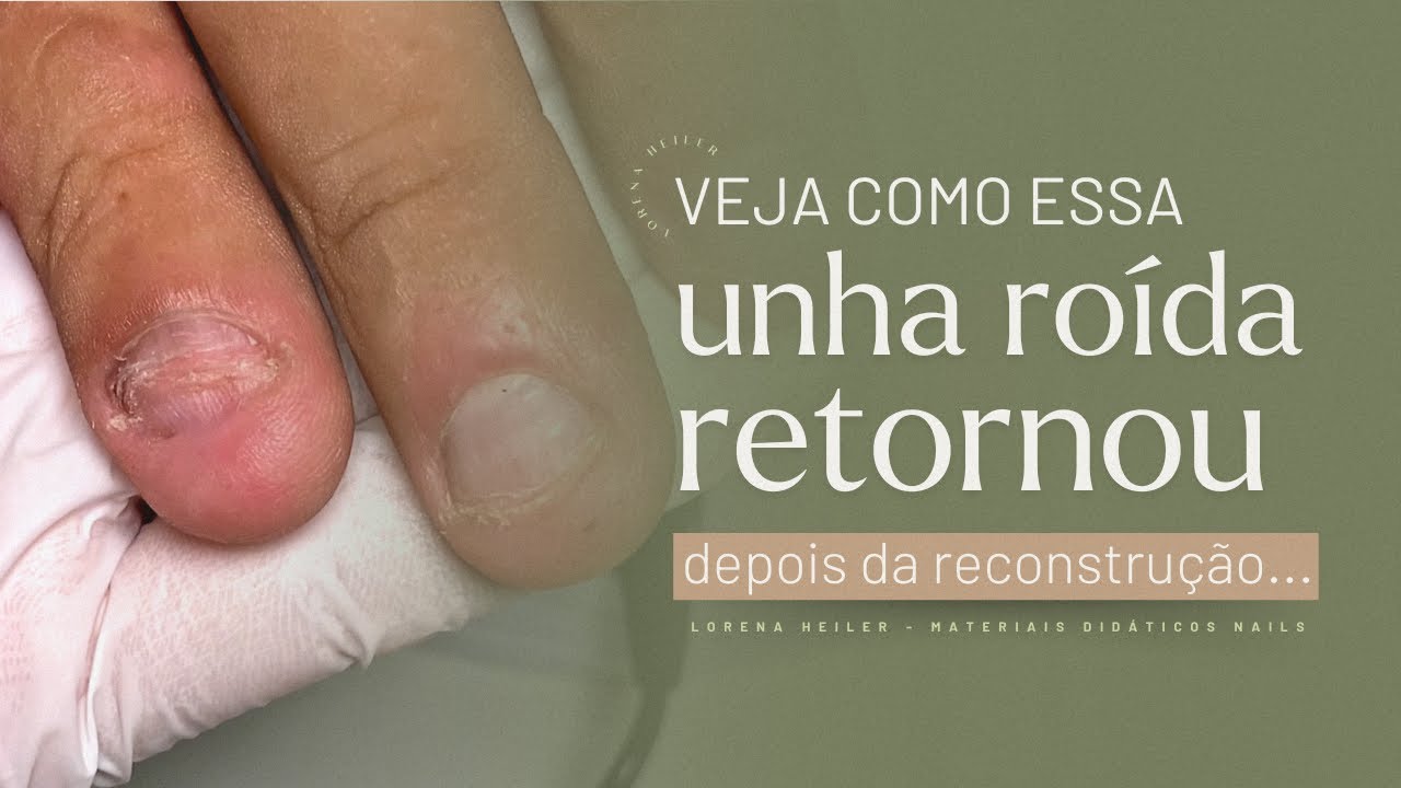 Reconstrução na UNHA ROÍDA - YouTube