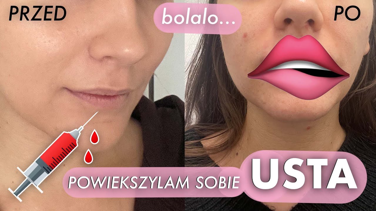 POWIĘKSZYŁAM SOBIE USTA! 👄😱 przed i po | cena | moje wrażenia - YouTube