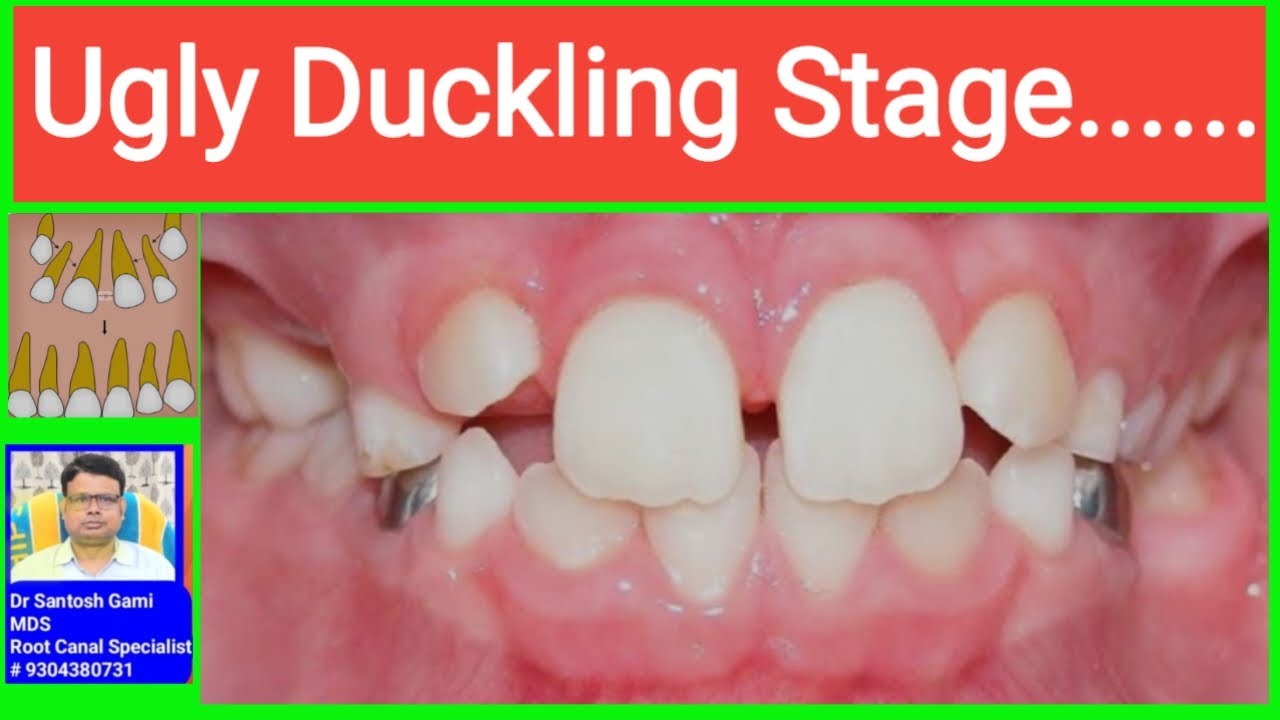 Ugly Duckling Stage......... - YouTube