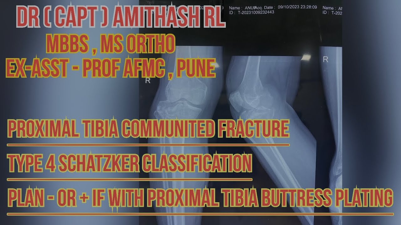 PROXIMAL TIBIA BUTTRESS PLATING BY DR (CAPT) AMITHASH - YouTube