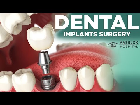 ⭐️Dental Implants Surgery | ✅Procedure Of Dental Implants | Aashlok Hospital