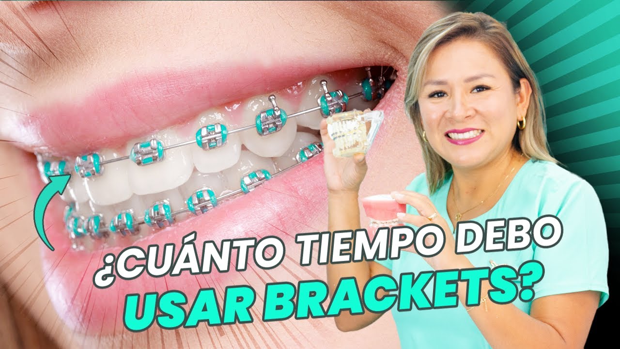 Brackets: ¿Cuánto Tiempo Durará Tu Tratamiento? - YouTube