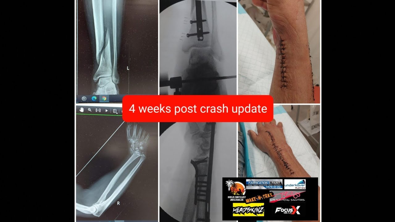 4 WEEKS POST CRASH UPDATE BROKEN LEG AND BROKEN ARM ( CREB TRACK FNQ ...