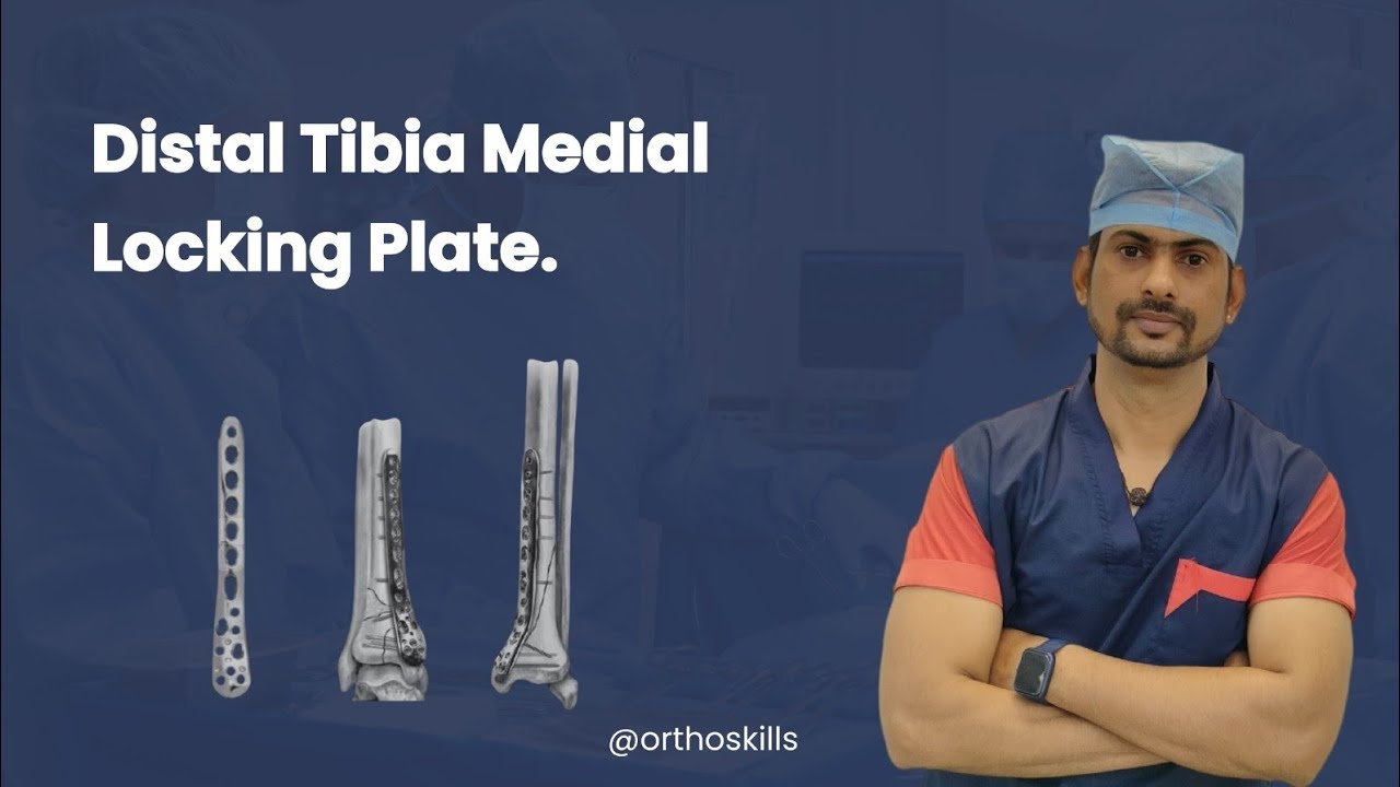 Distal Tibia Medial Locking Plate.Distal Tibial plates.Medial Distal ...