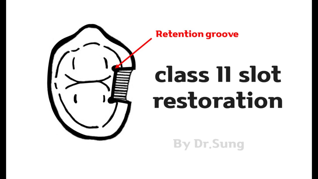 class II MO Slot Restoration with Retention Grooves for Amalgam_ Max ...