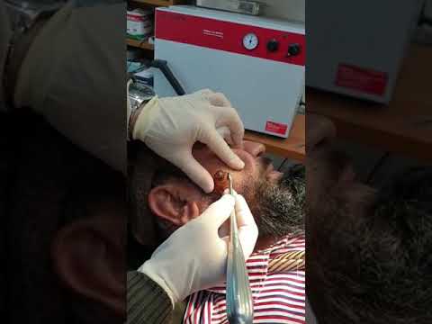 Demo-14: Removal of a large "Pyogenic Granuloma" on the face by simple ...