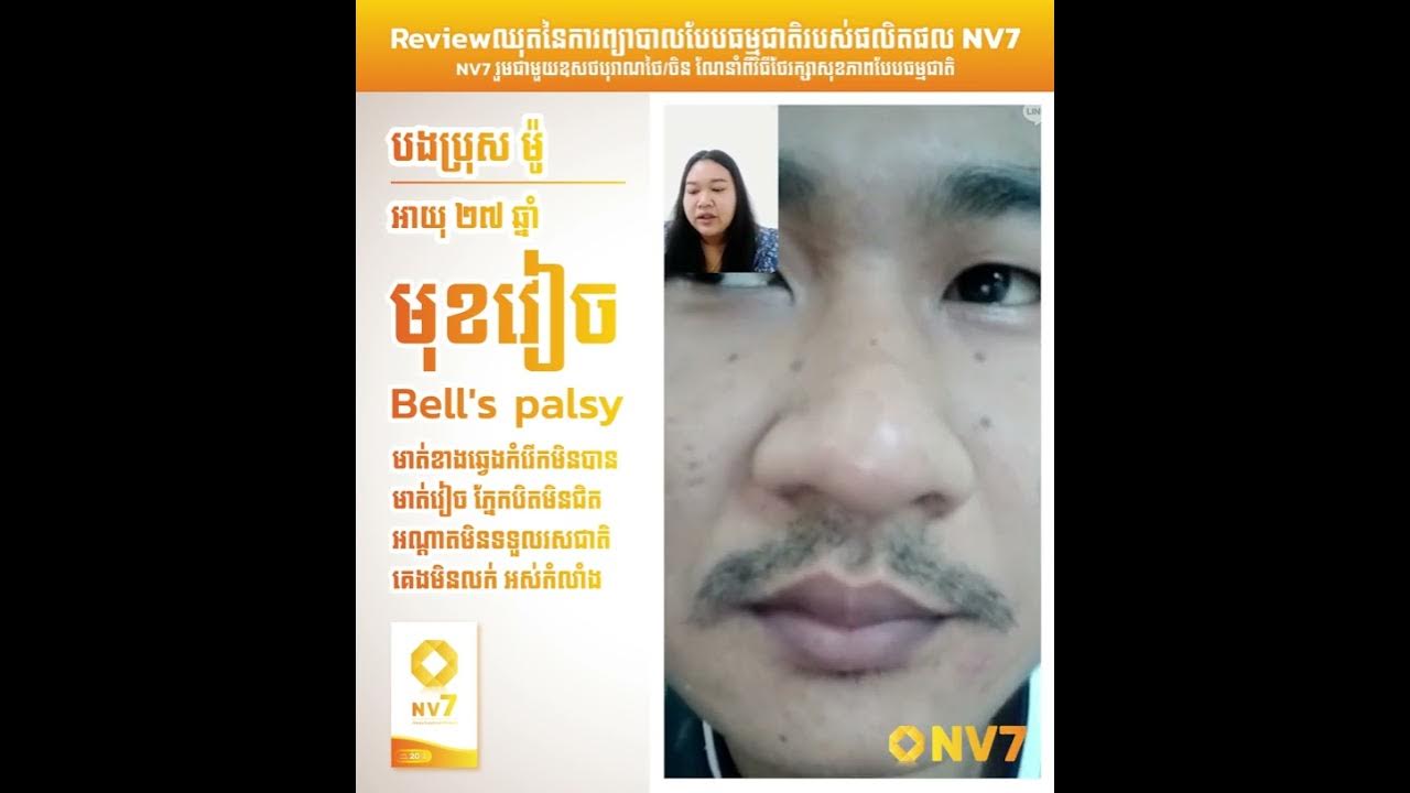 *NV7Review បងប្រុស ម៉ូ មុខវៀច Bell's palsy មាត់ខាងឆ្វេងកំរើកមិនបានមាត់វៀច អណ្តាតមិនទទួលរសជាតិ ...