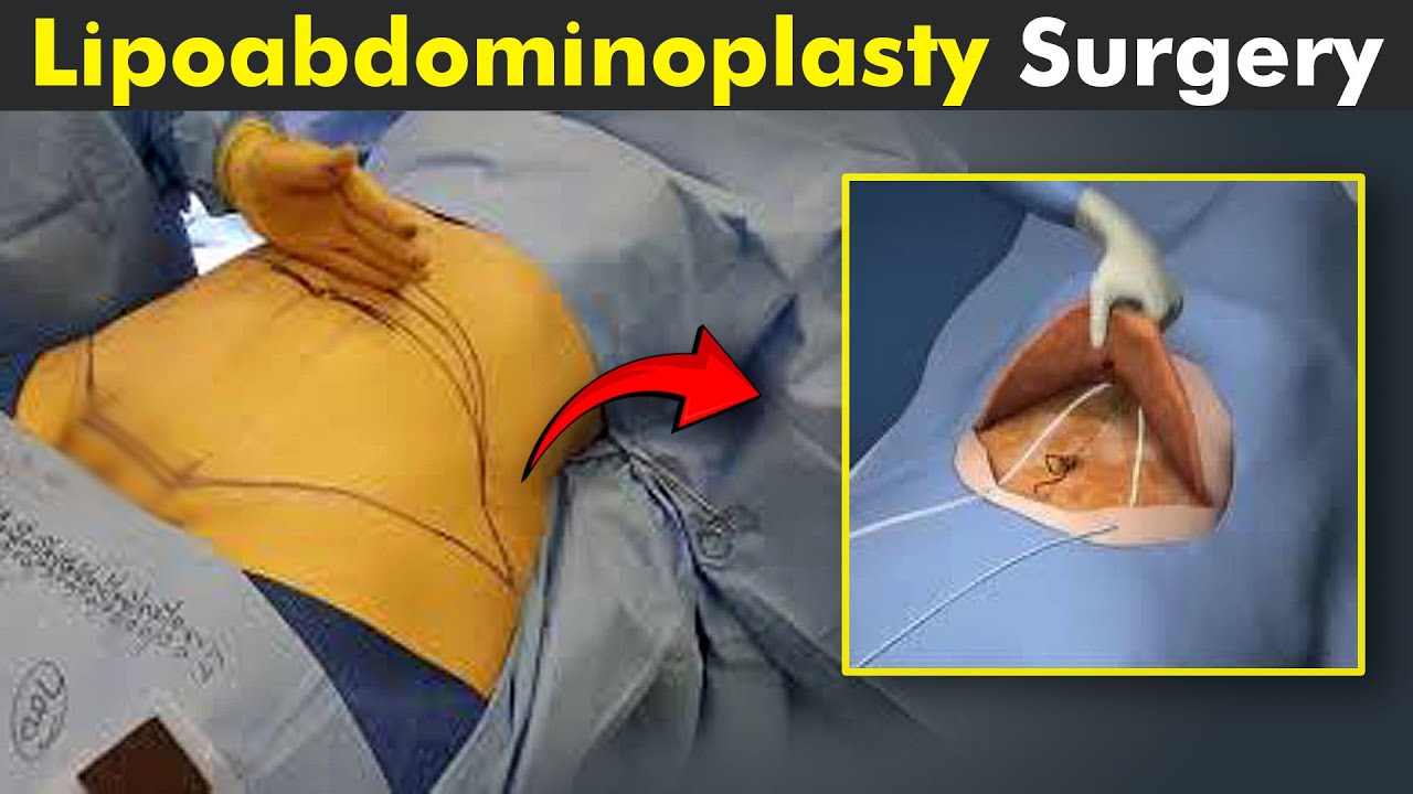 Liposuction Meets Tummy Tuck: The Ultimate Guide to Lipoabdominoplasty ...
