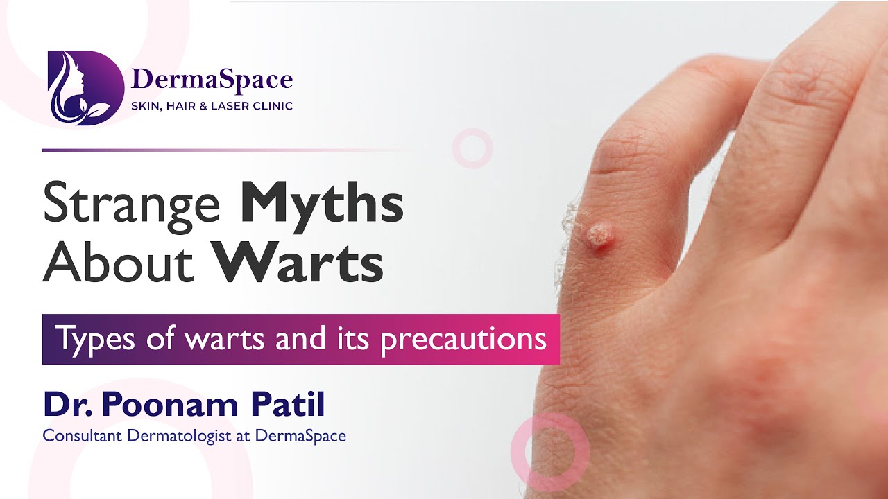Strange myths about Warts | Types of warts and its precautions | Dr ...