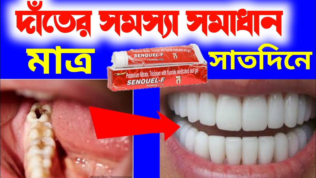 Heavy easy teeth treatment||clean and remove pain by Senquel F tooth ...