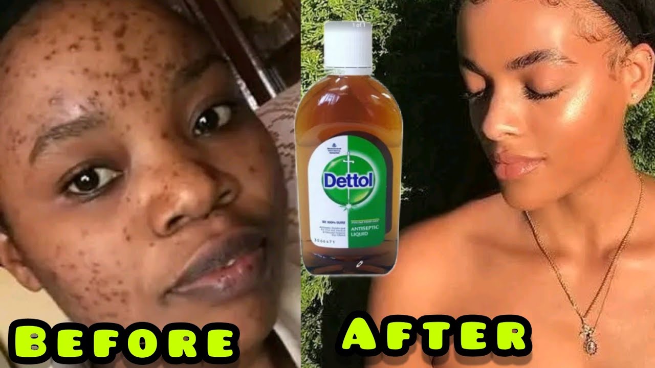 How To Use Dettol Antiseptic Liquid Clear body Acnes ||How To get rid ...