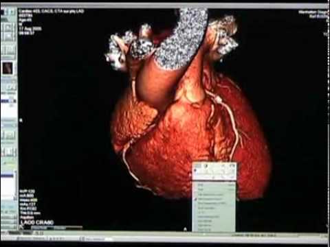 Vital Images - Vitrea Enterprise Suite 1.3 - YouTube