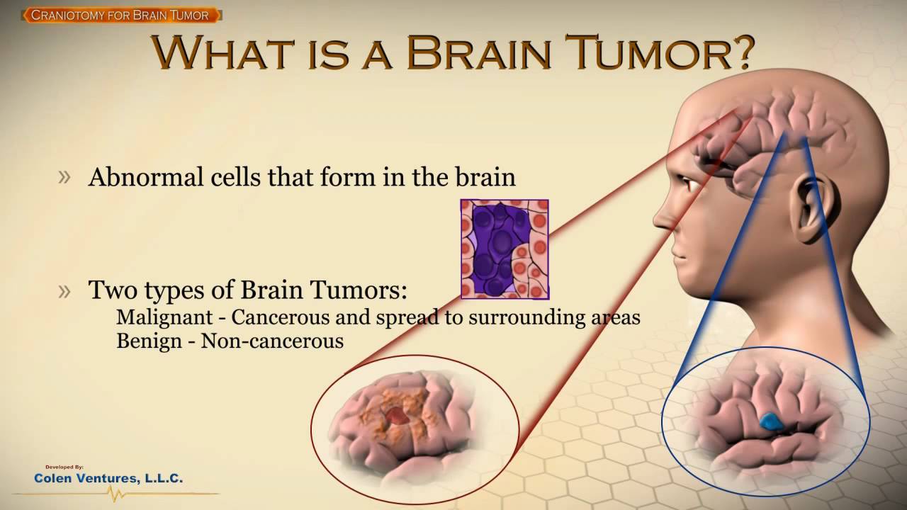 Clip from Craniotomy for Brain Tumor Medi-DVD - YouTube