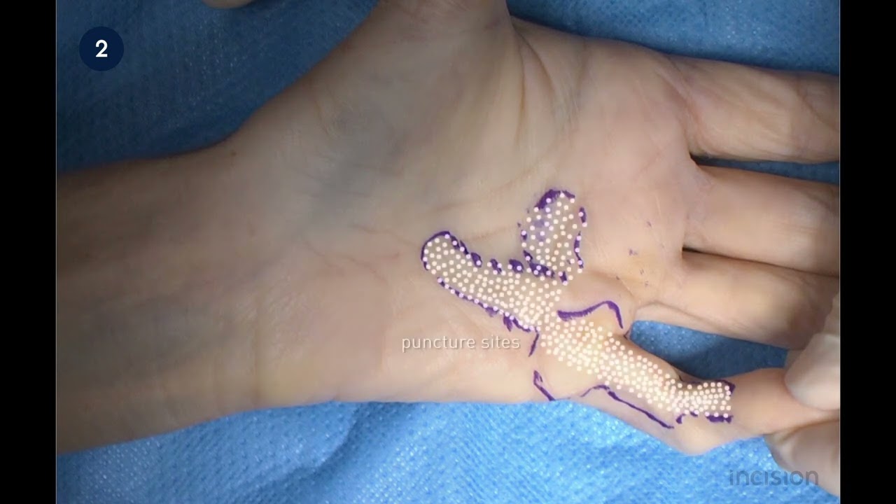 Dupuytren needle aponeurotomy - YouTube